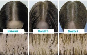 Nanoxidil for Hair Loss: Efficacy, Side-Effects, vs. Minoxidil - Hairverse